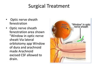 begnin intracranial hypertension.pptx