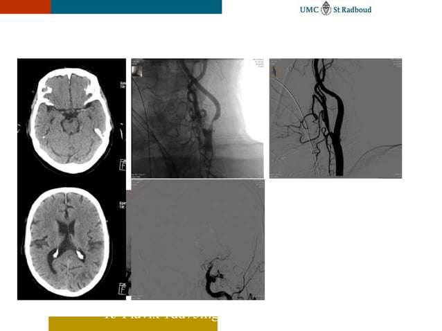 Sessie 3: Behandeling van cerebrovasculaire ziekten | PPT