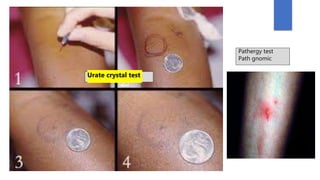 Behcet disease | PPTX