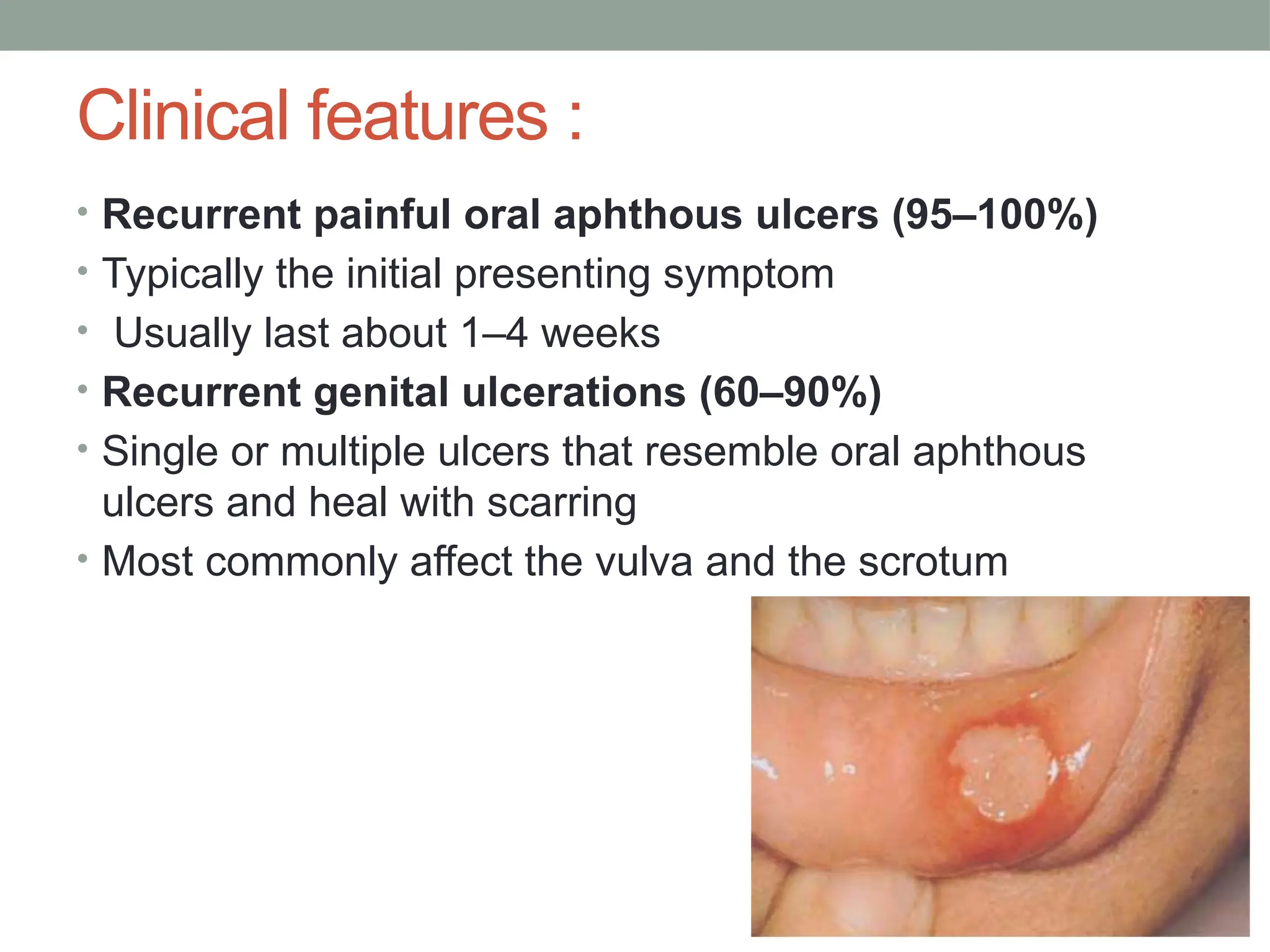 Behcet disease presentation .pptx