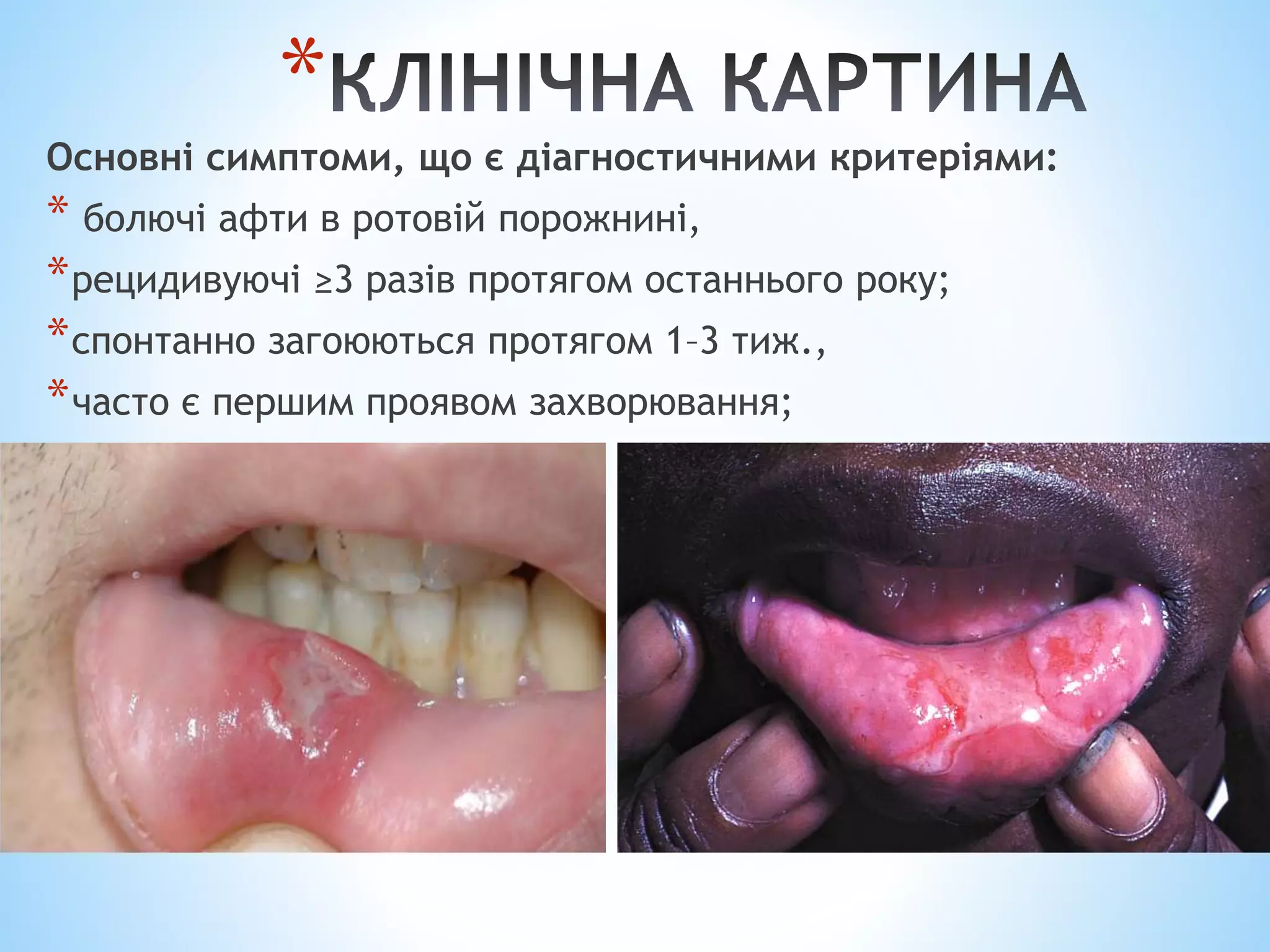 Behcet's disease | PPTX