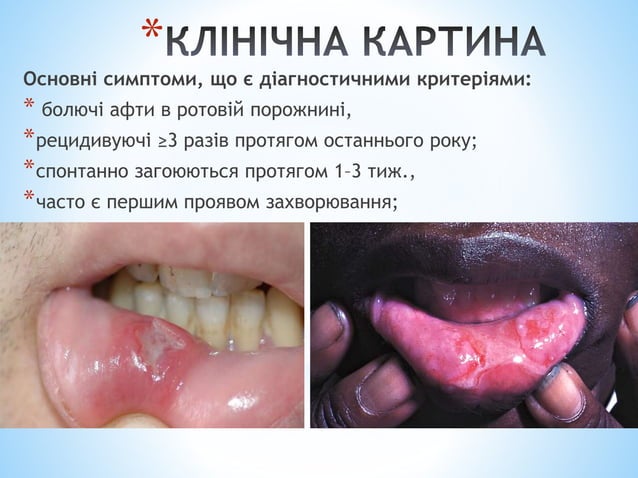 Behcet's disease | PPTX