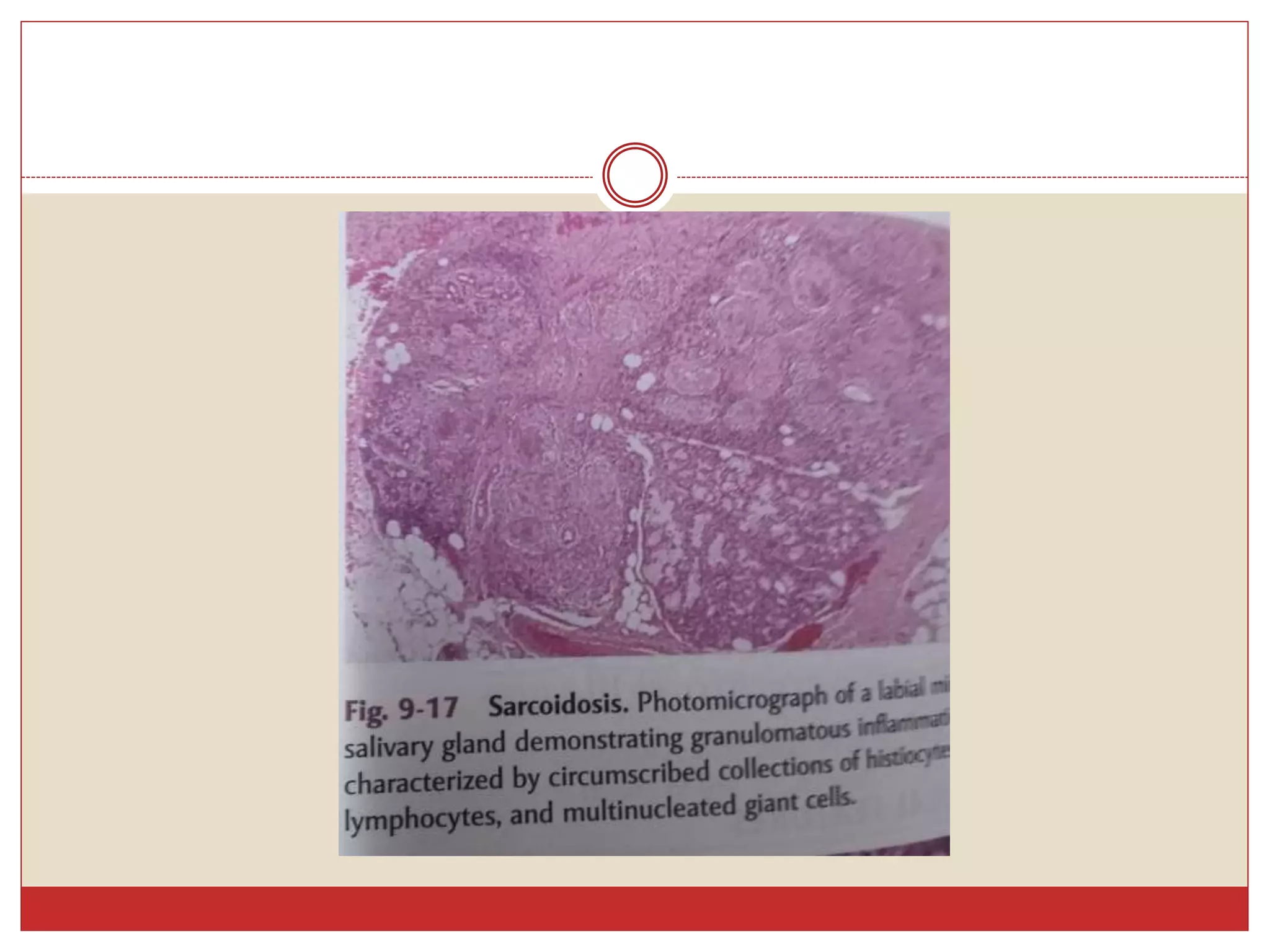 Behcet _s_syndrome_reiter___s_syndrome_and_sarcoidosis | PPT