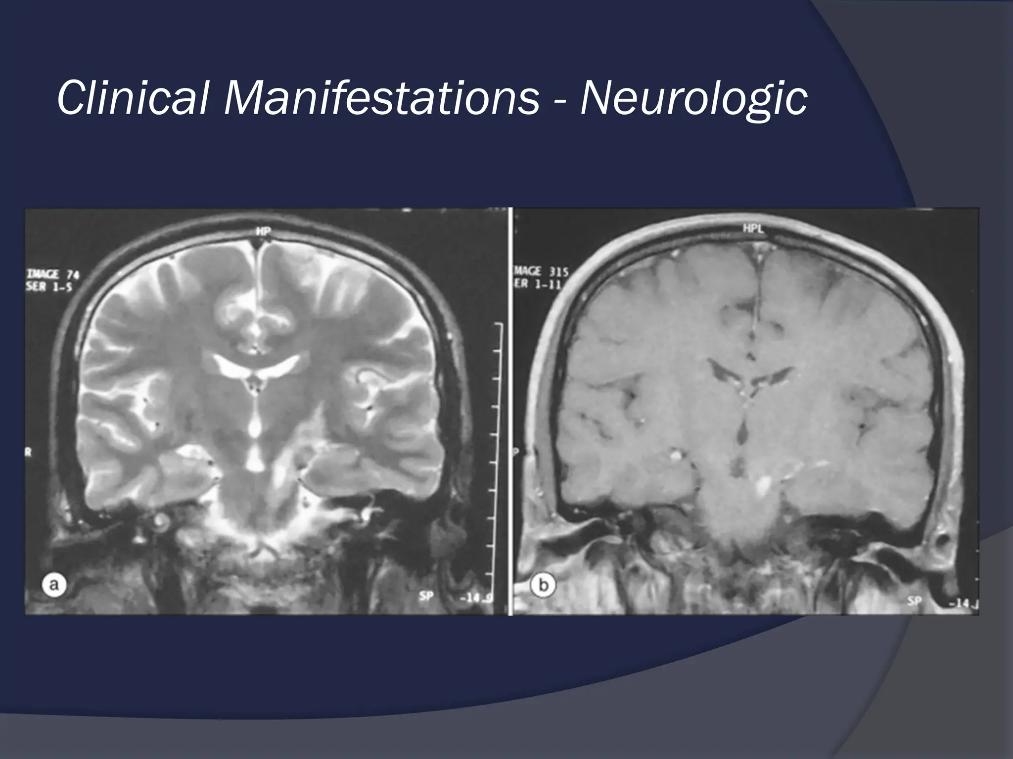 Behcet's syndrome for medical student revised | PPTX