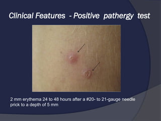 Behcet's syndrome for medical student revised | PPTX | Digestive ...