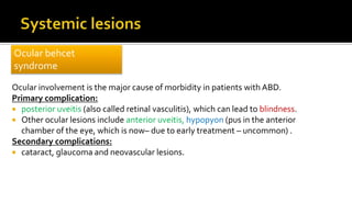 Behçet Disease.pptx