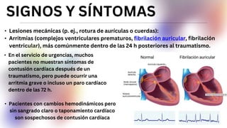 Contusión Miocárdica | PPTX