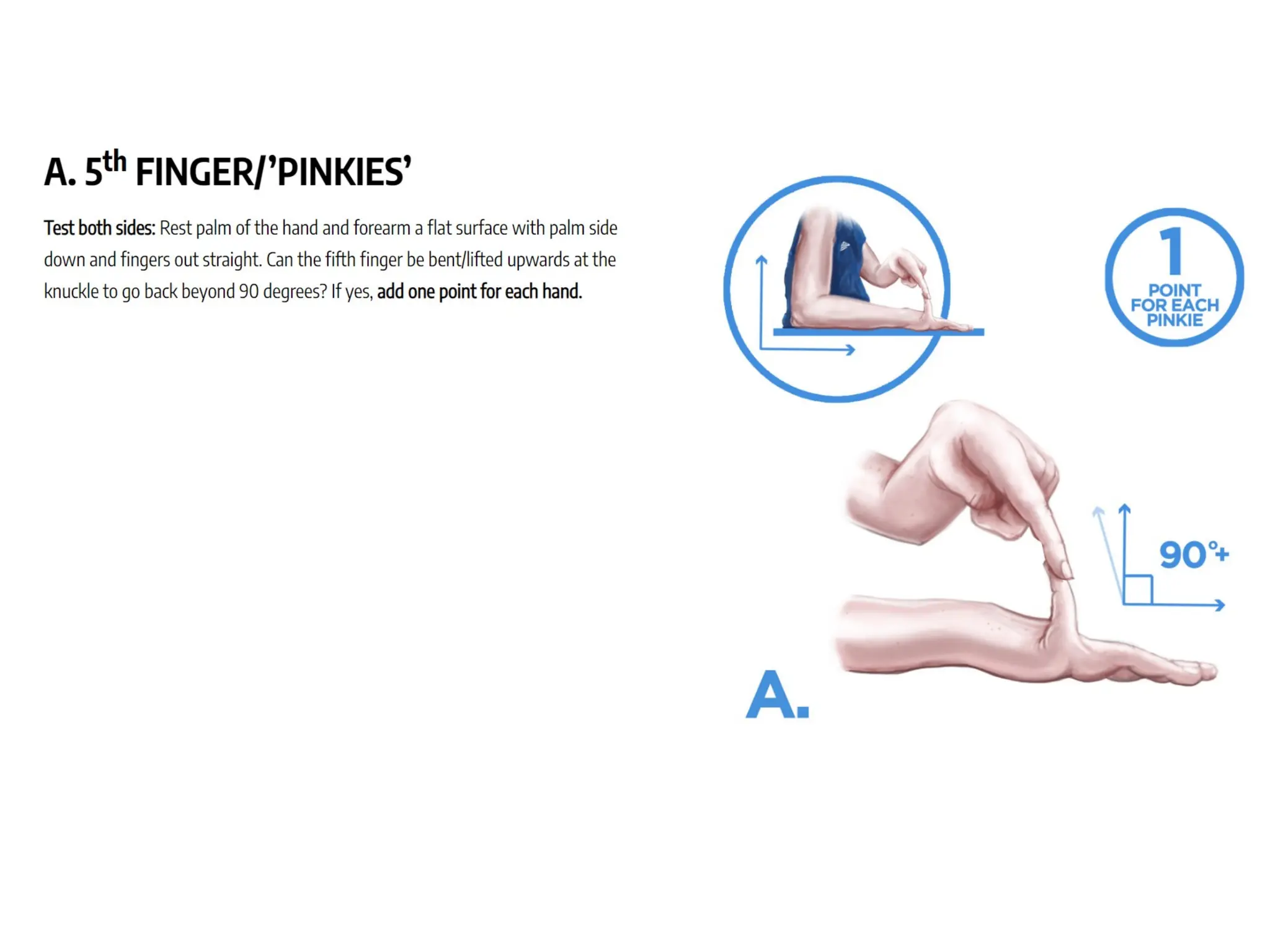 Beighton Score For Hypermobile Syndrome Ppt