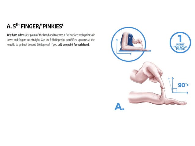 BEIGHTON SCORE FOR HYPERMOBILE SYNDROME, | PPT