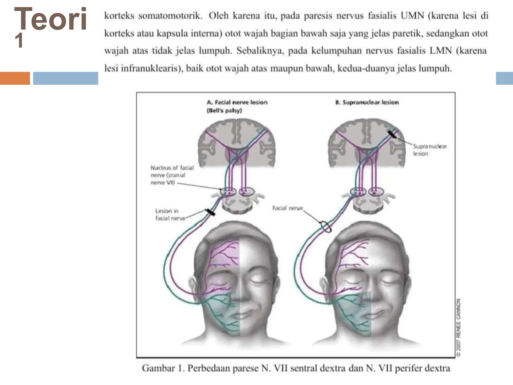Belajar Parese Nervus VIIedit260123.pptx