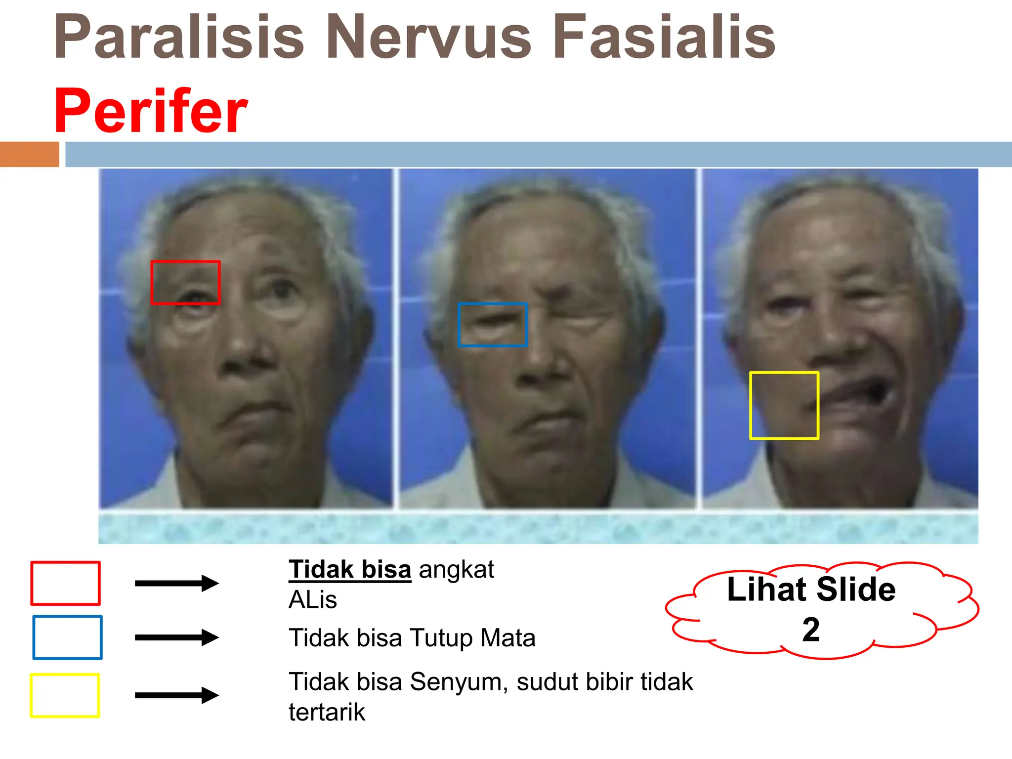 Belajar Parese Nervus VIIedit260123.pptx