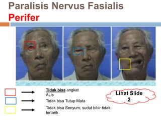 Belajar Parese Nervus VIIedit260123.pptx