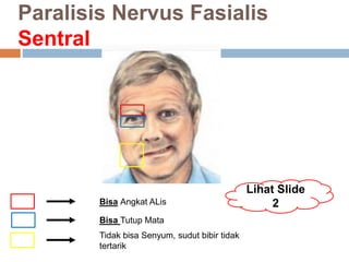 Belajar Parese Nervus VIIedit260123.pptx