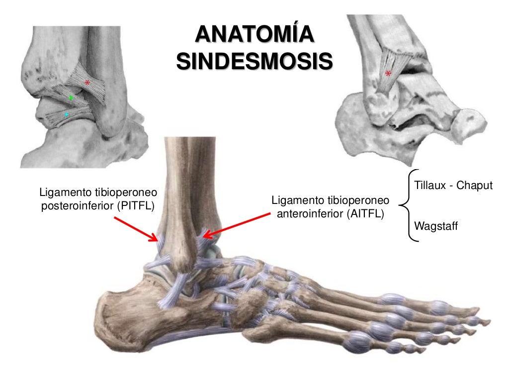Belen Ñiguez. Abordaje en fracturas del maleolo tibial posterior