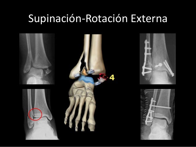Belen Ñiguez. Abordaje en fracturas del maleolo tibial posterior