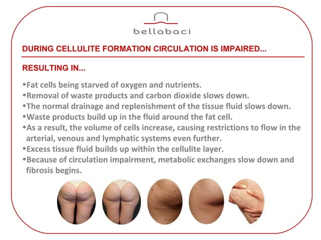 Cellulite treatment with cupping therapy massage by bellabaci | PPT