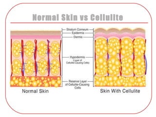 Cellulite treatment with cupping therapy massage by bellabaci | PPT ...