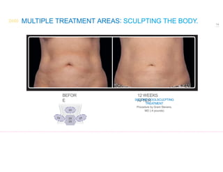 Coolsculpting /guidebook | PPTX
