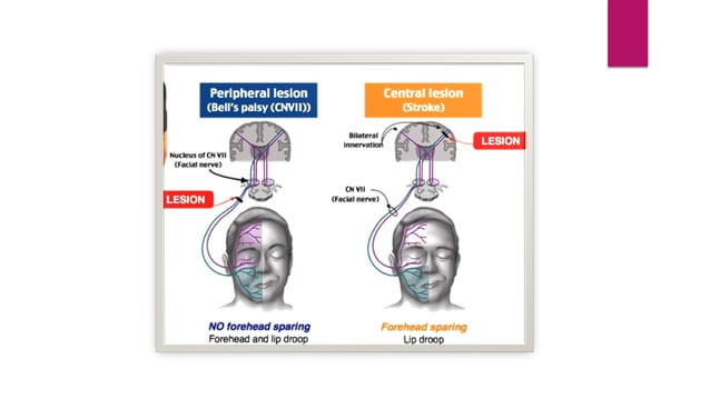 Bell's Palsy | PDF | Ear, Nose and Throat Conditions | Diseases and ...