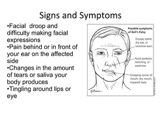 Bell’S Palsy | PPT