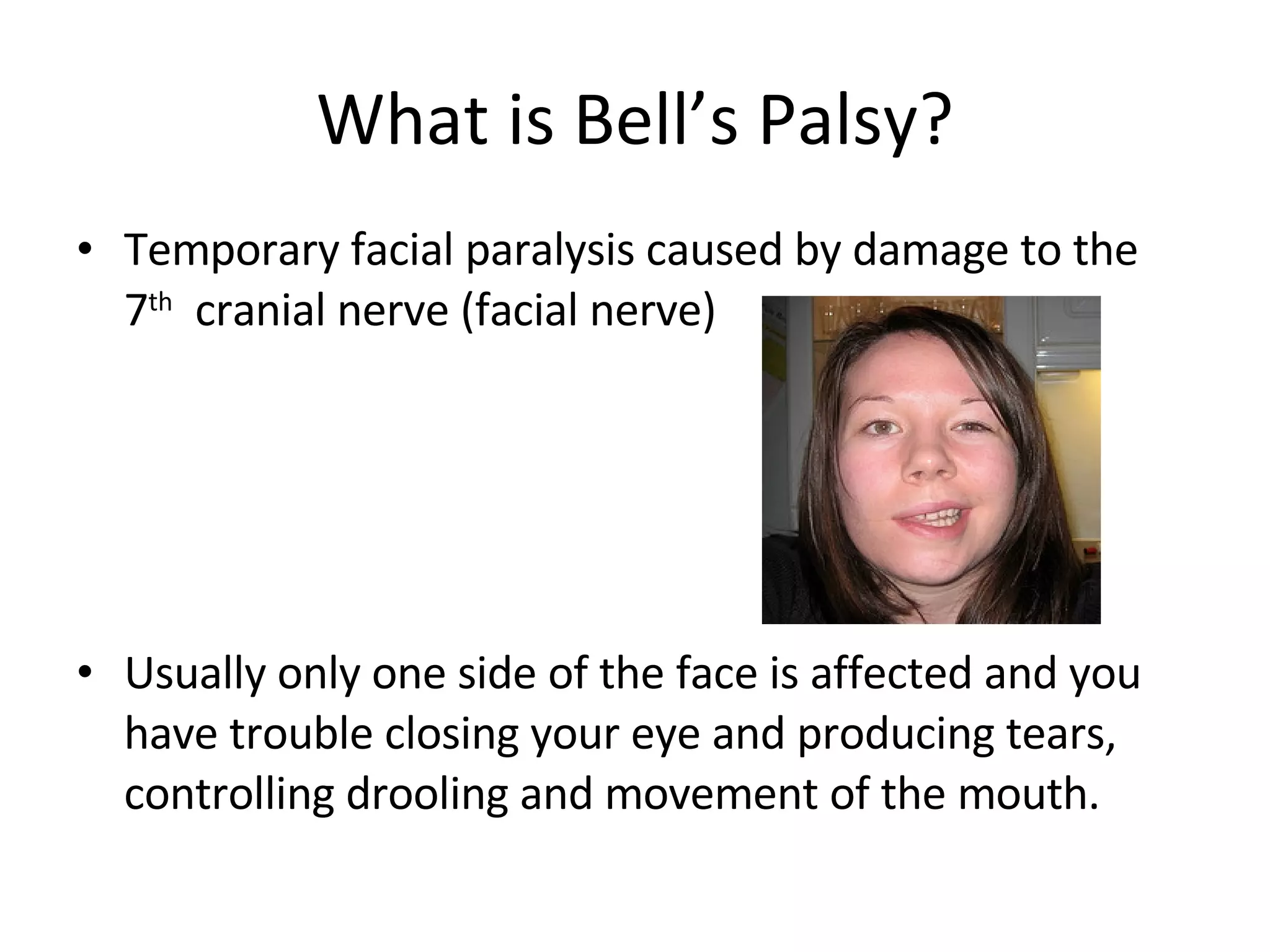 Bells Palsy Part 1 | PPT