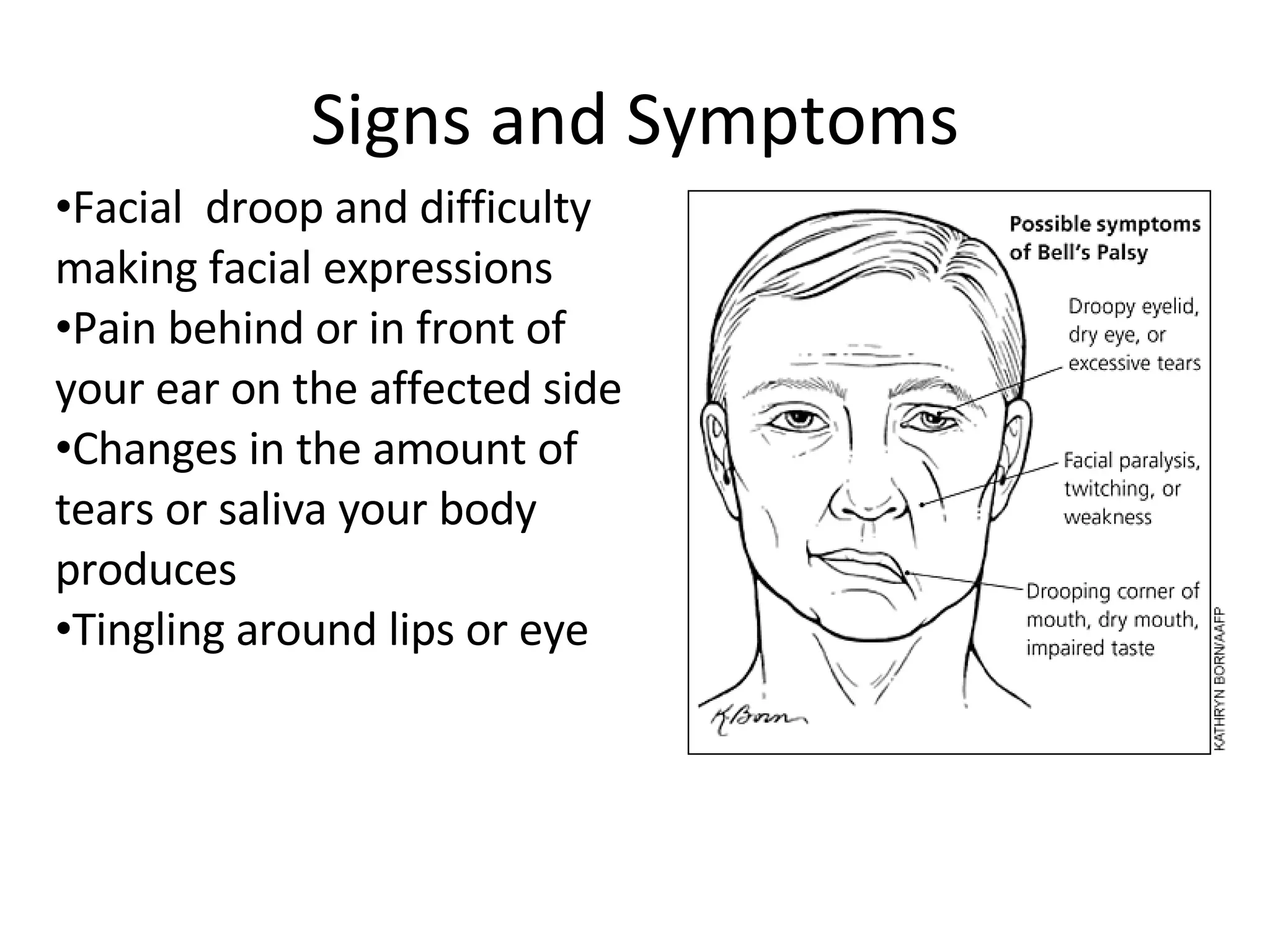 Bells Palsy Part 1 | PPT