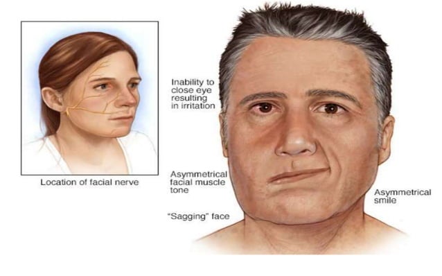 Bell’s Palsey.pptx