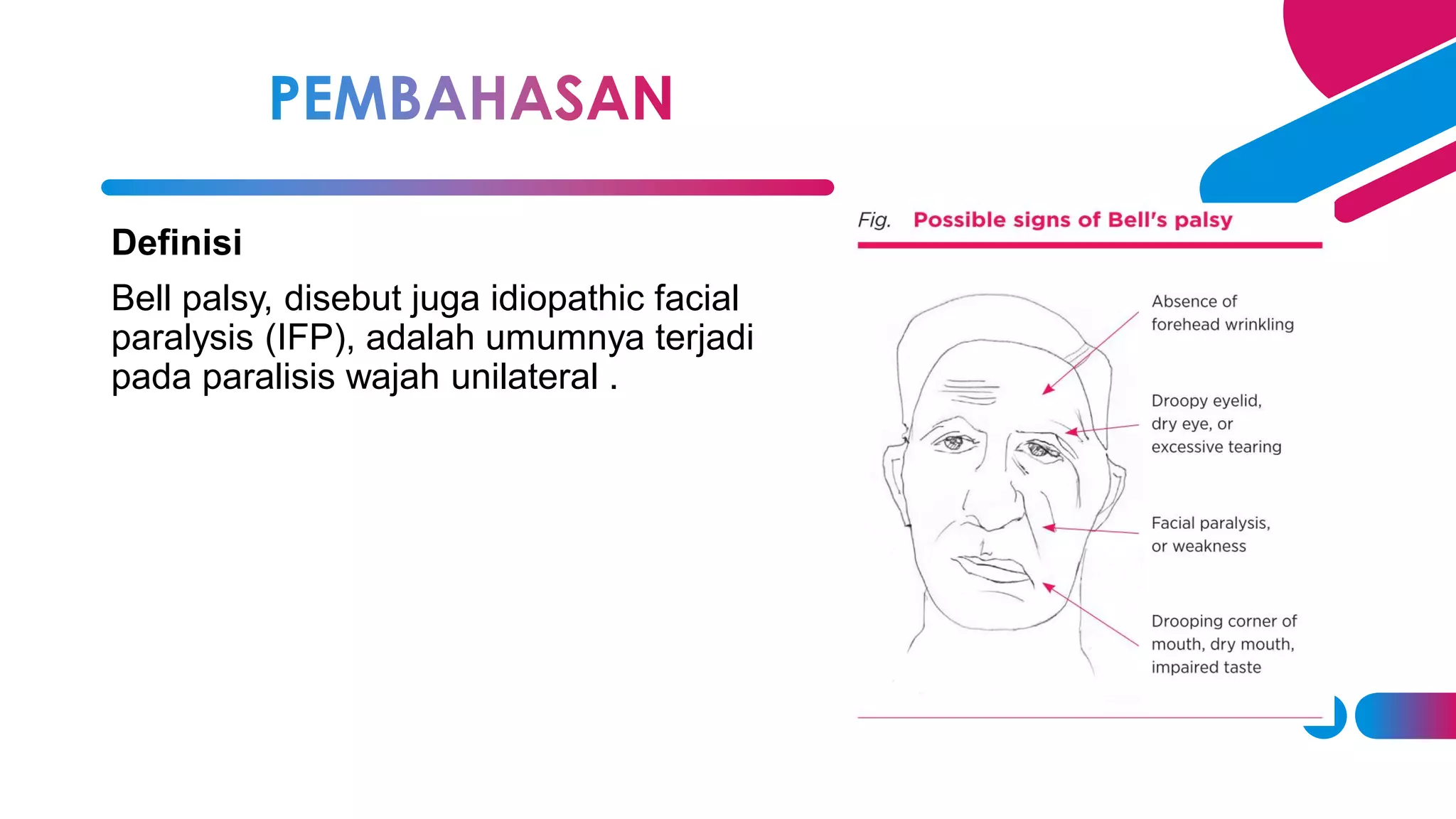 Laporan Kasus Bell's palsy | PDF