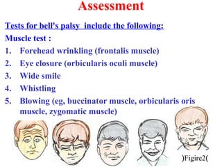 Bells palsy | PPT