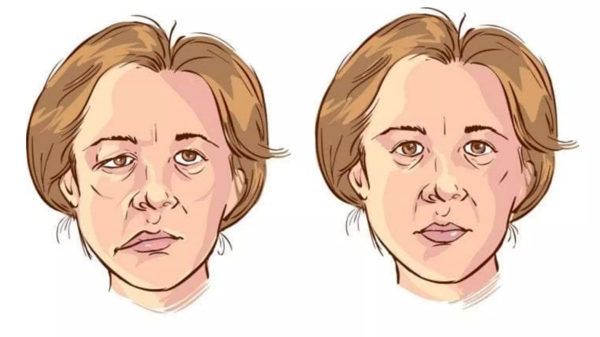 Bell's palsy | PPTX