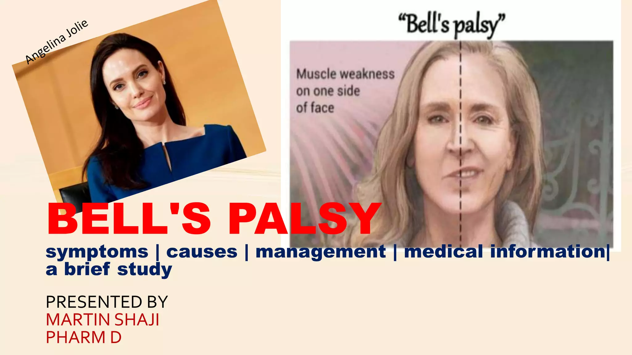 Bells palsy-causes |management |a brief medical study | PPT