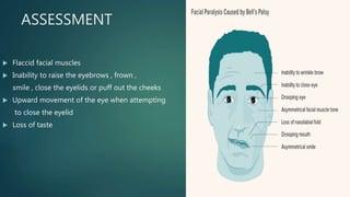 BELL’S PALSY.pptx