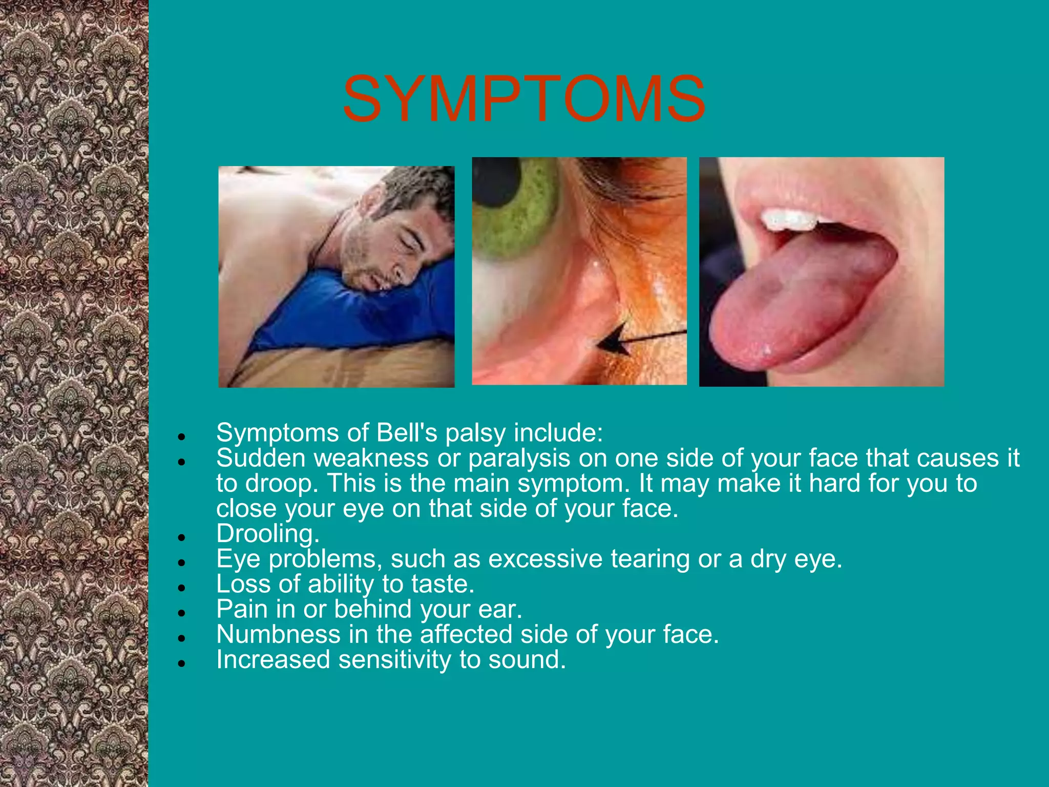 BELL’S PALSY.ppt.pptx | Ear, Nose and Throat Conditions | Diseases and ...
