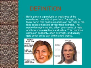 BELL’S PALSY.ppt.pptx | Ear, Nose and Throat Conditions | Diseases and ...
