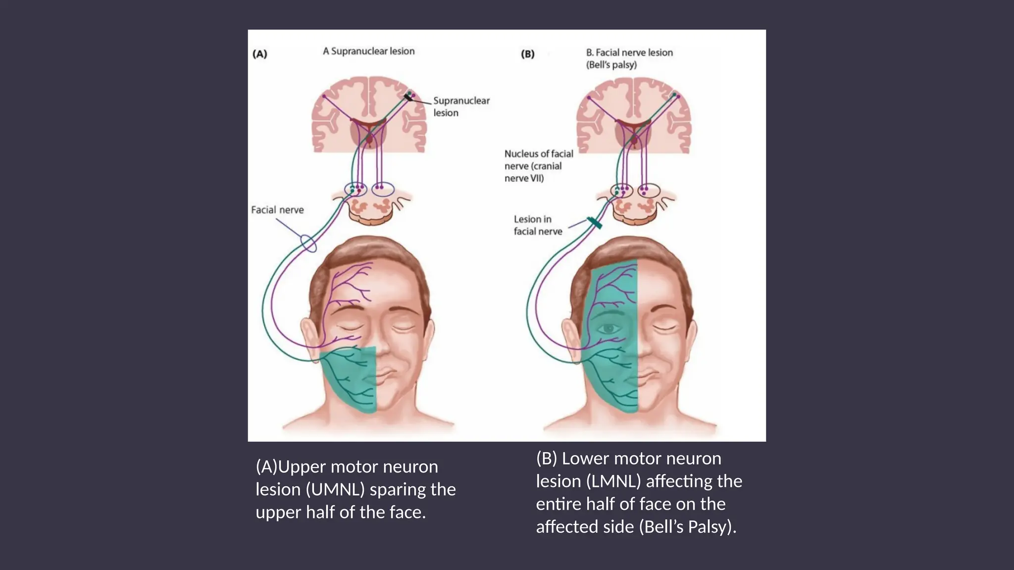bells palsy.pptxNerve Injuries from Mandibular Third Molar Removal ...