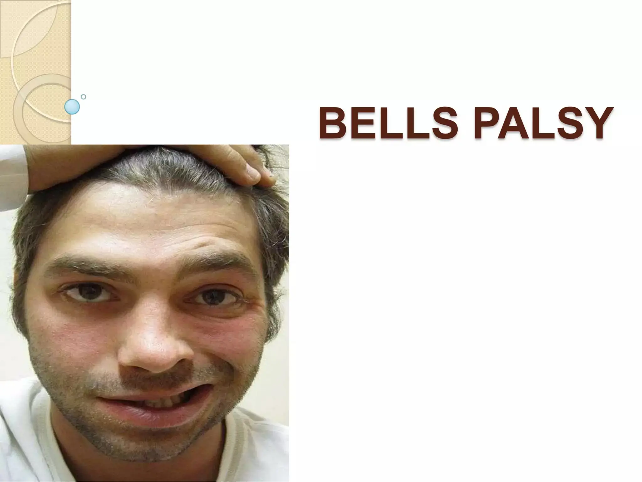 Bell’s palsy pdf presentations for ug students | PDF