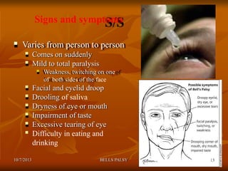 bells palsy signs, symptoms and management | PPTX