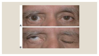 Bell's phenomenon anatomy mechanism clinical significance | PPTX
