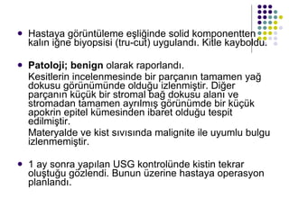 intrakistik papiller meme kanseri | PPT
