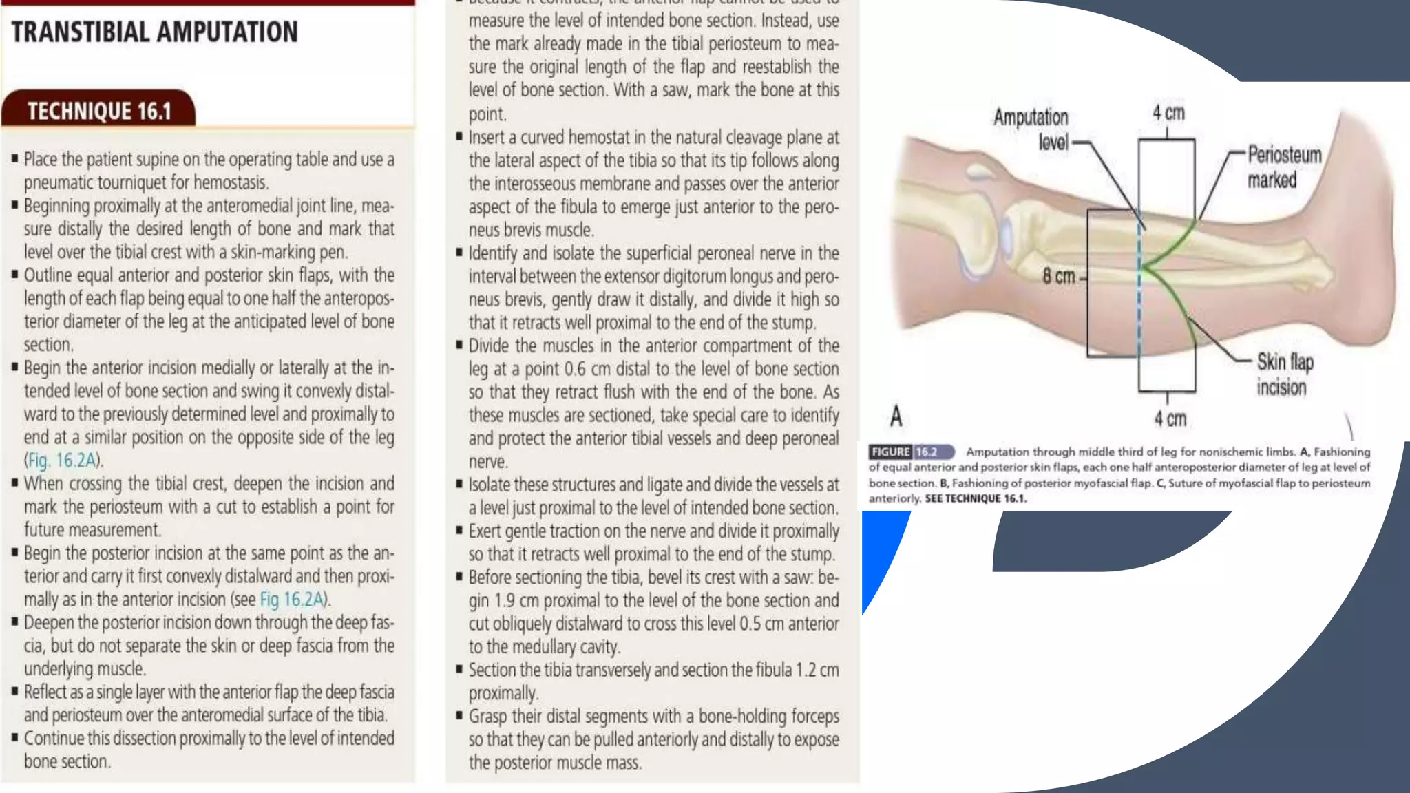 below knee amputatin.pptx