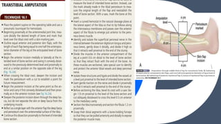 below knee amputatin.pptx