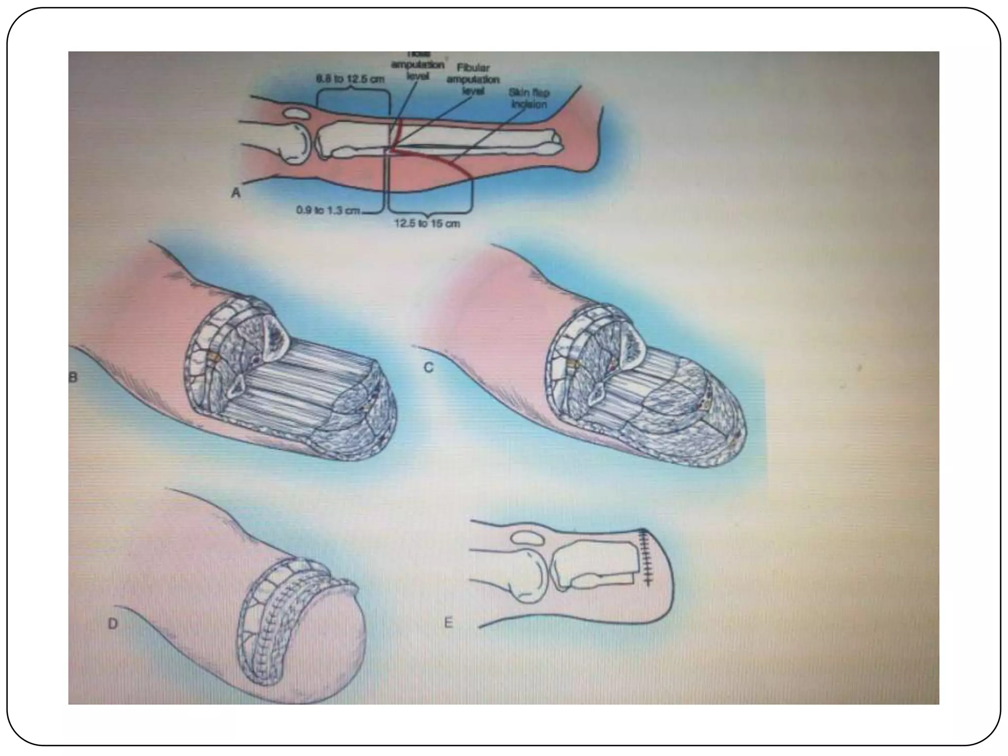 Below knee amputation | PPTX