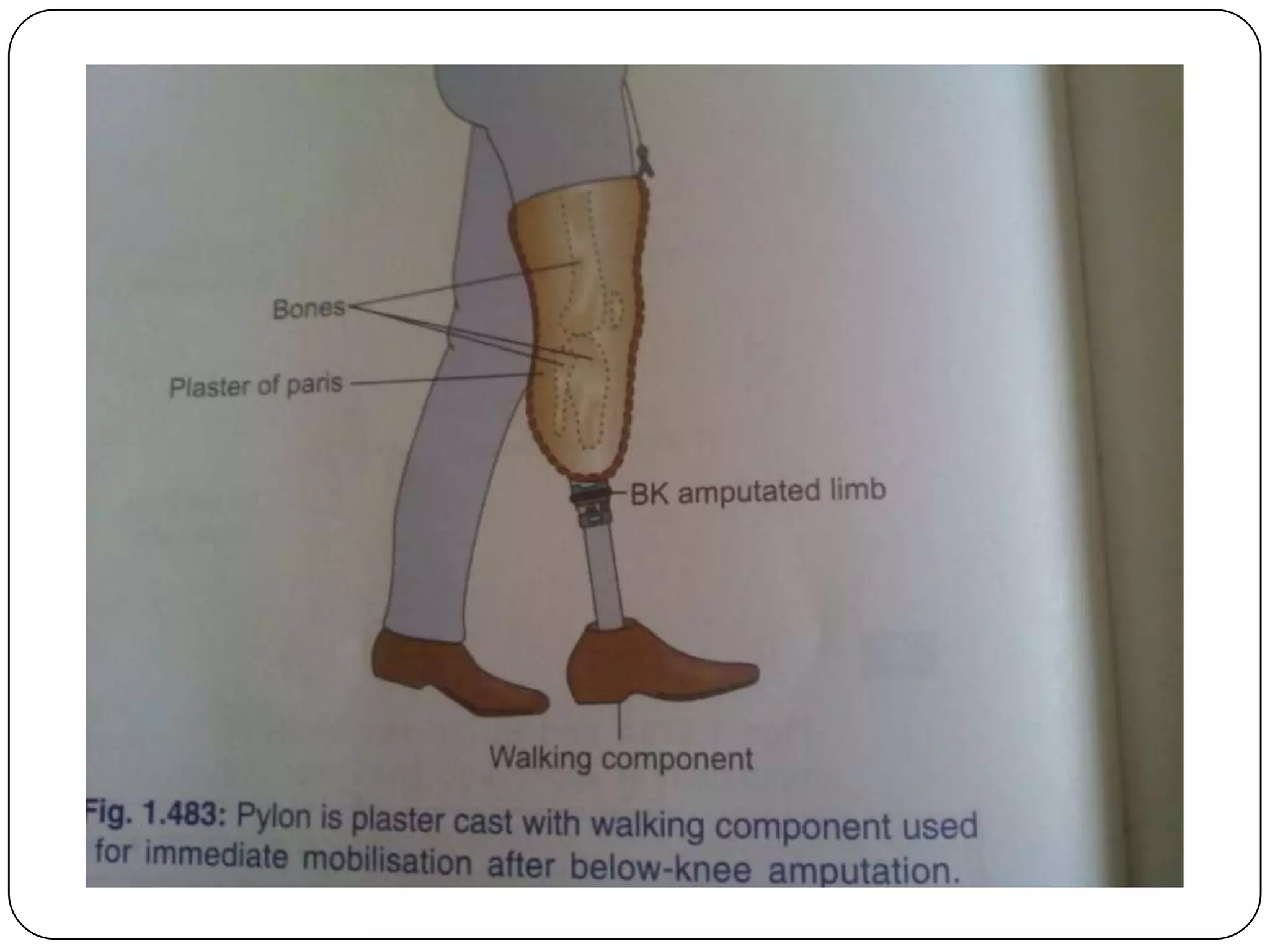 Below knee amputation | PPTX