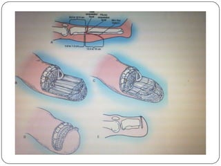 Below knee amputation | PPTX