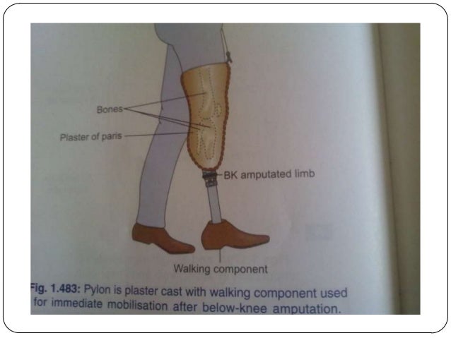 Below knee amputation