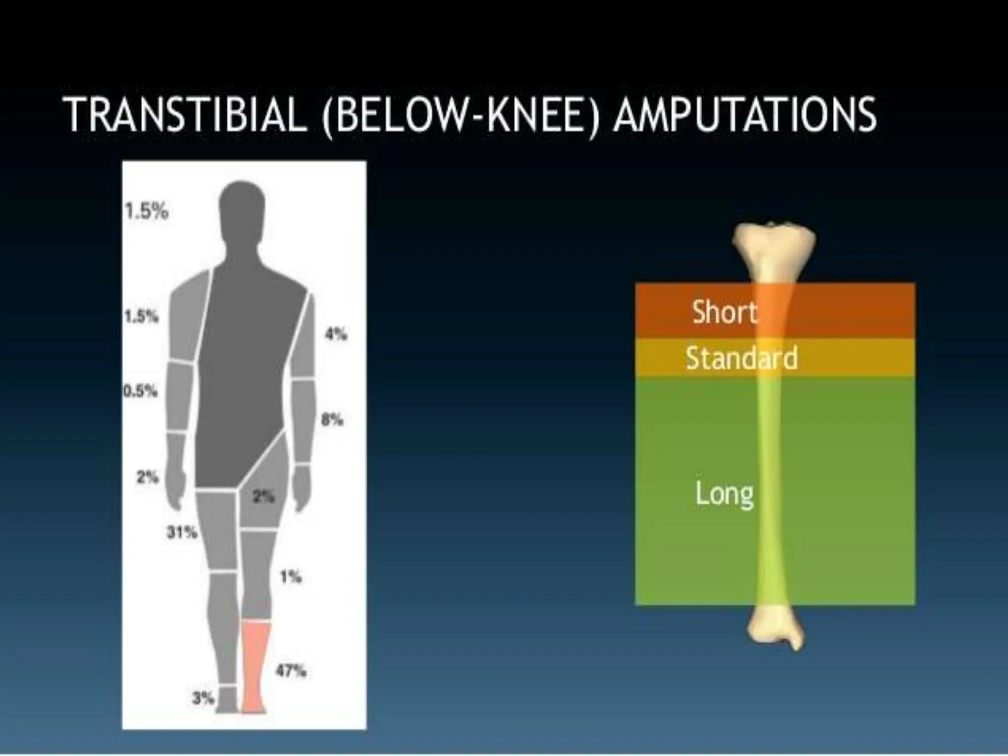 Below knee amputation and its Rehabilitation.pptx