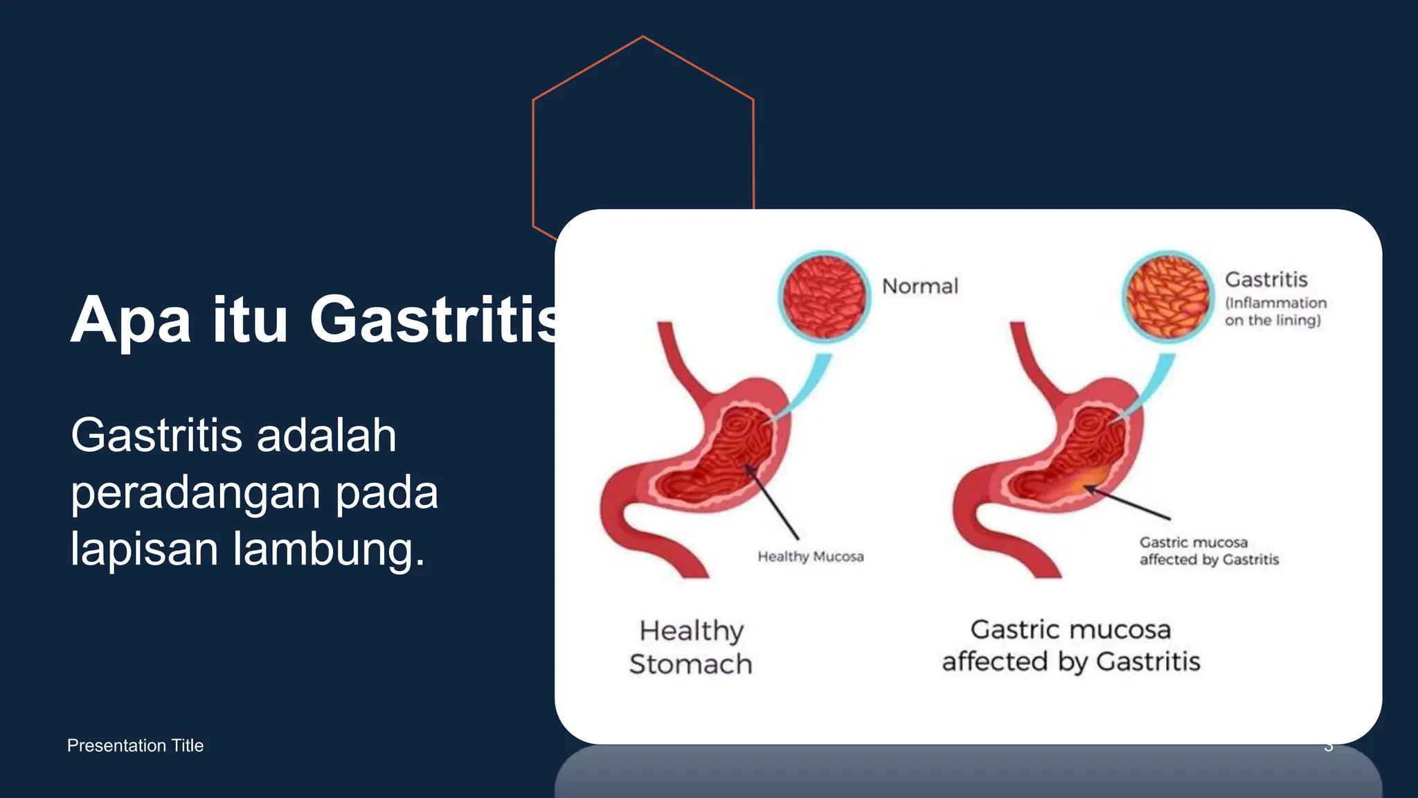 Benarkah Penyakit Lambung (Gastritis) menyebabkan darah.pptx