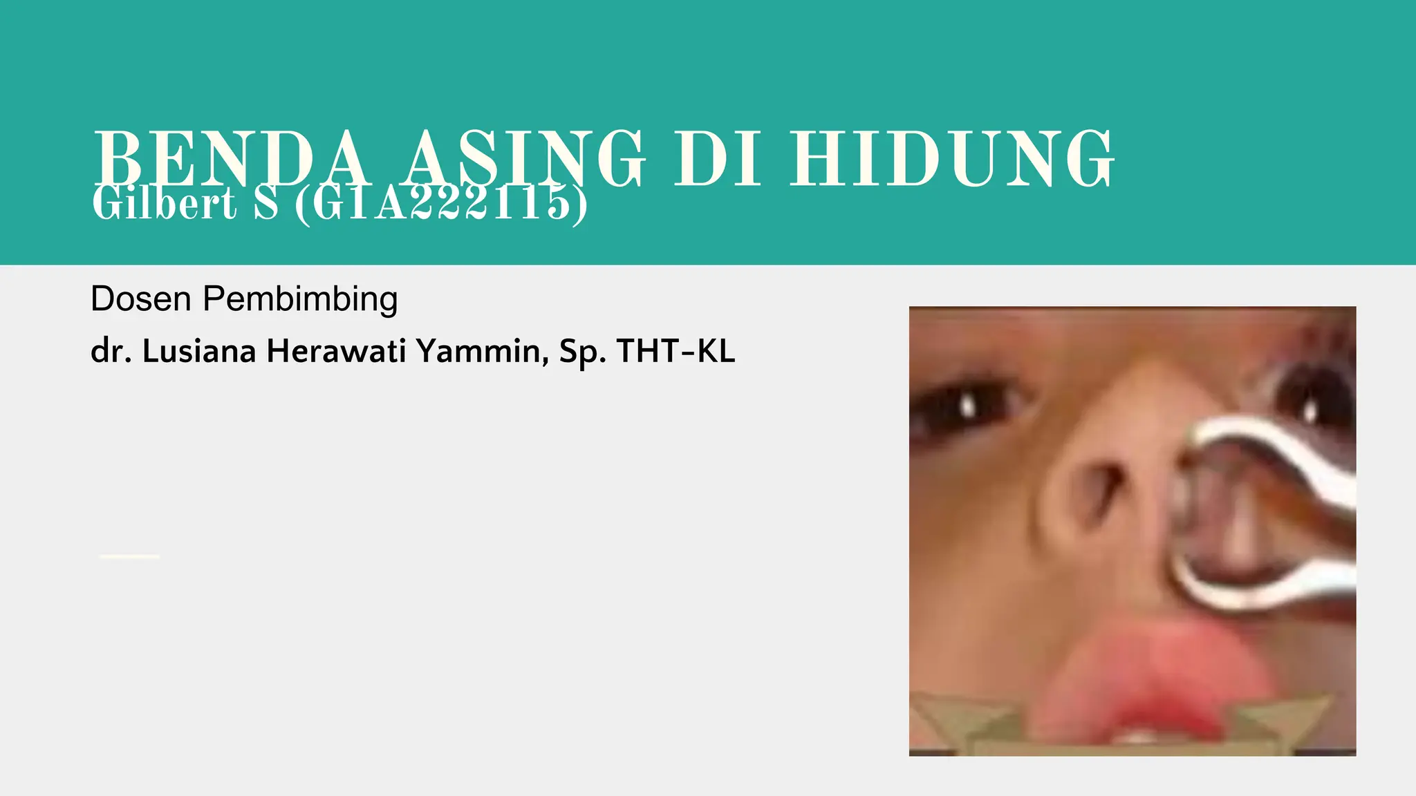 Benda Asing Hidung THT Gilbert Dicoba ajar | PPTX
