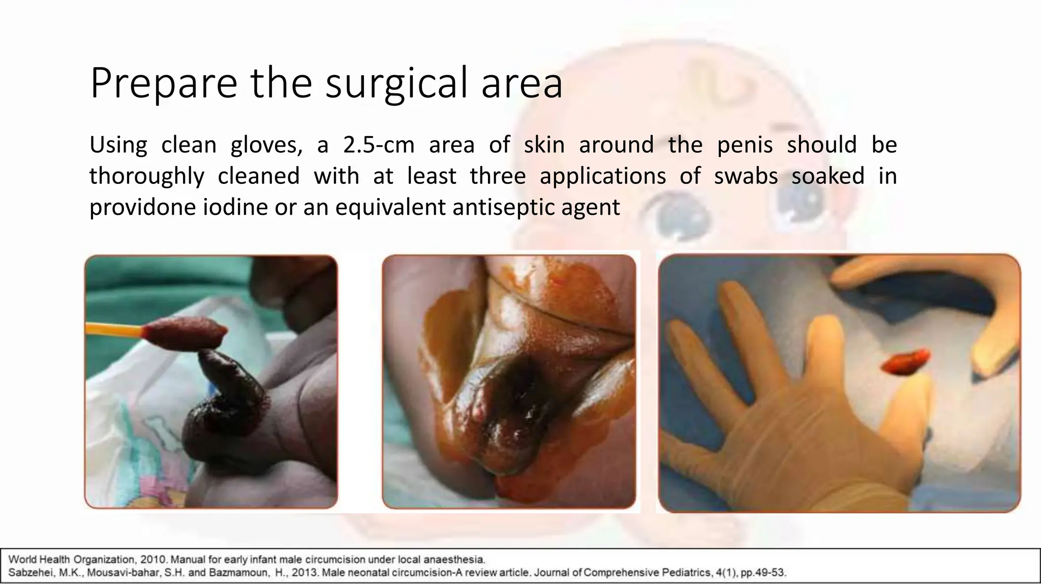 THE BENEFIT OF NEONATAL CIRCUMCISION.pptx