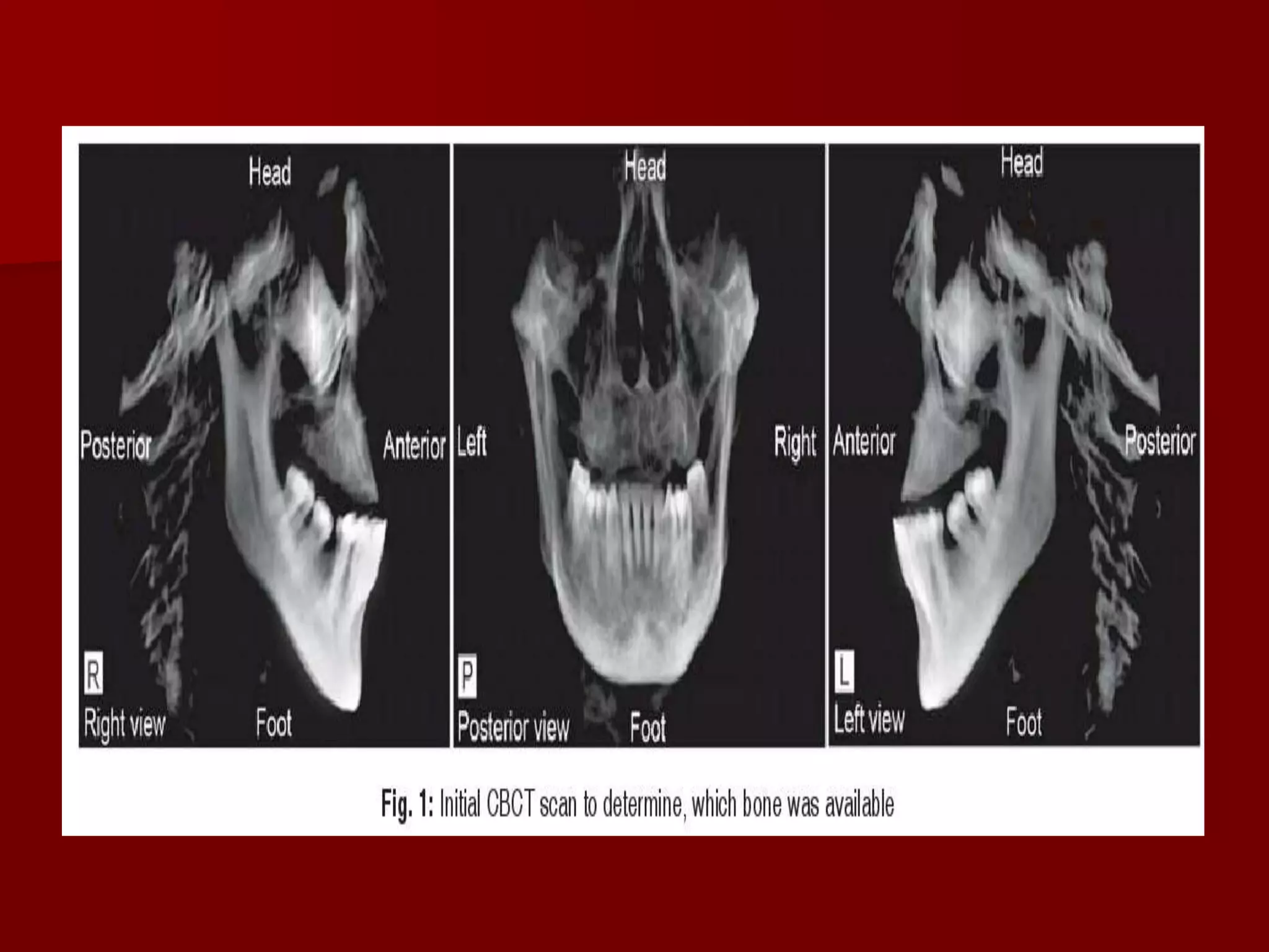 Benefits of cbct in implant planning | PPTX